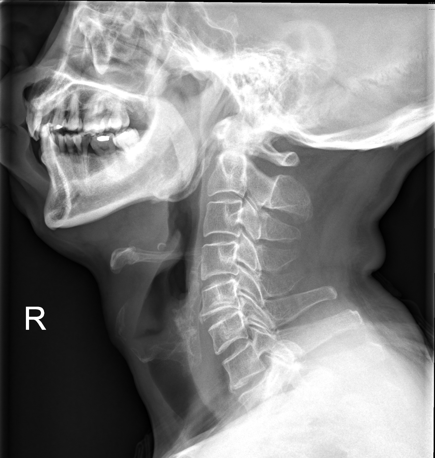 FOREIGN BODY IN GI TRACT Buyxraysonline FOREIGN BODY IN GI TRACT Buyxraysonline