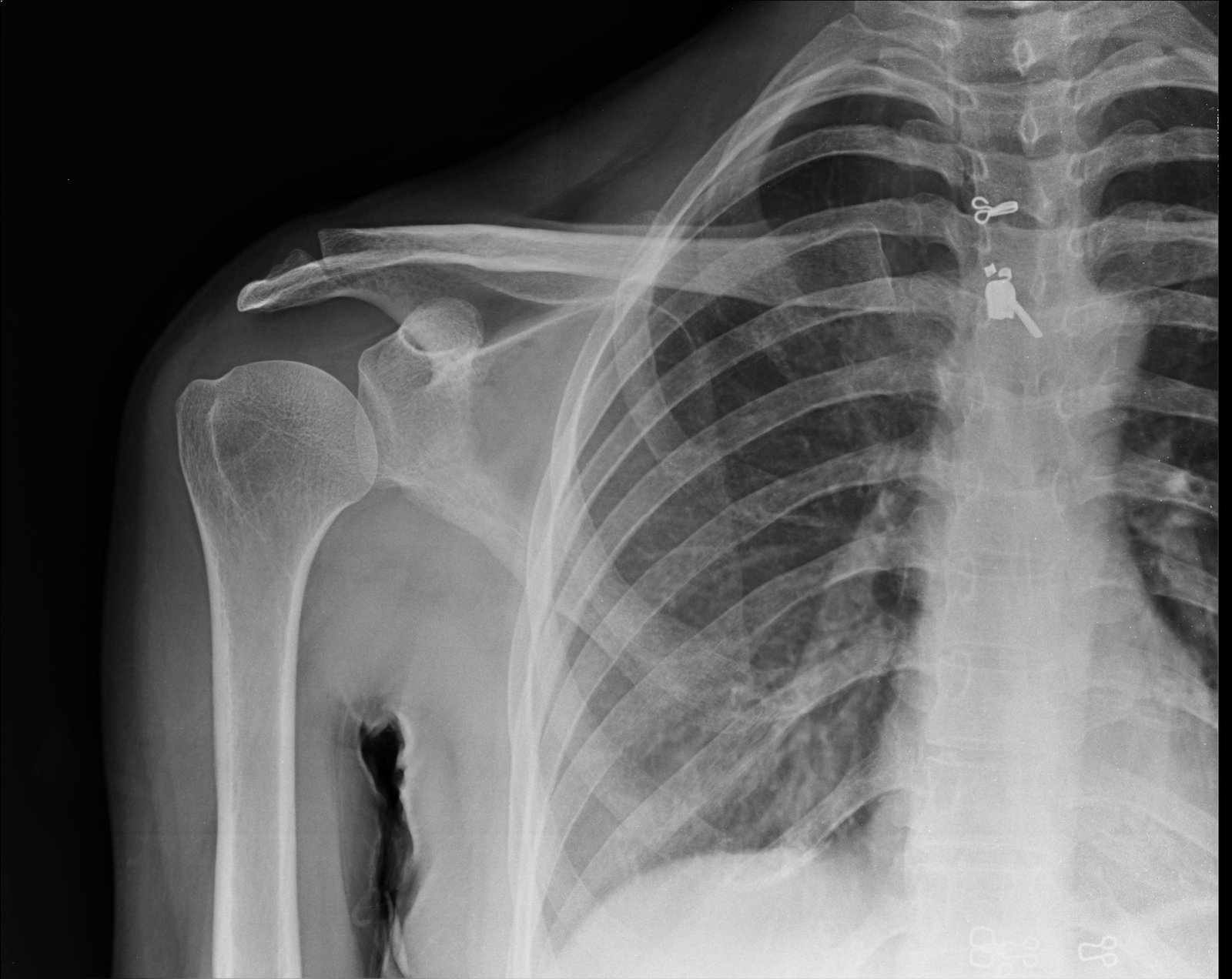 ACROMIOCLAVICULAR JOINT INJURY Buyxraysonline