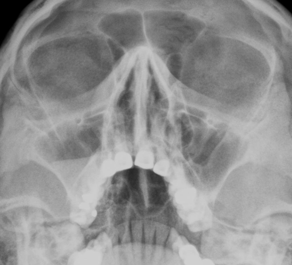 ACUTE MAXILLARY SINUSITIS Buyxraysonline ACUTE MAXILLARY SINUSITIS Buyxraysonline