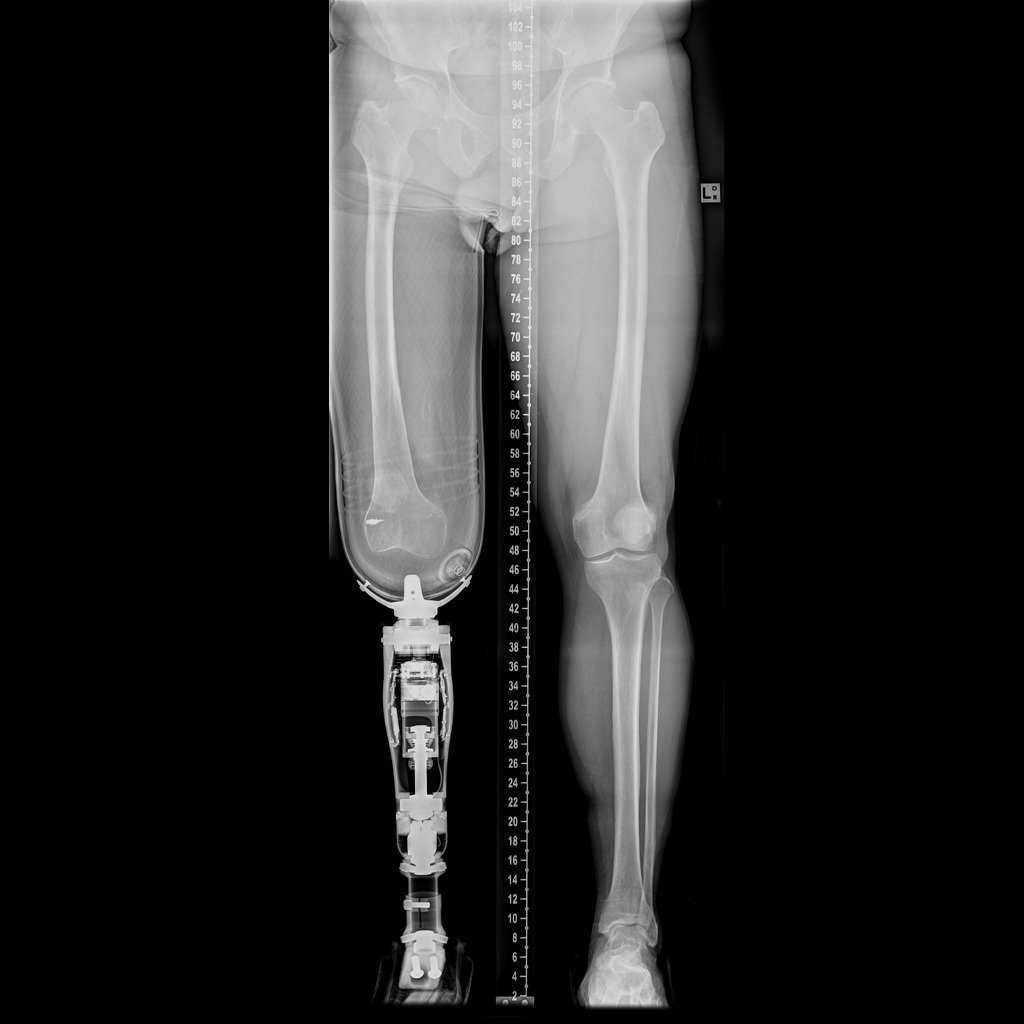 ARTIFICIAL LEG Buyxraysonline ARTIFICIAL LEG Buyxraysonline