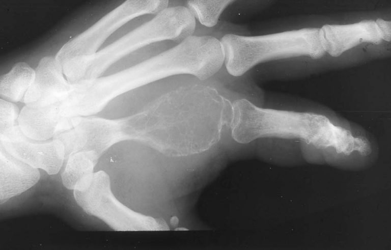 Giant Cell Tumor Hand Buyxraysonline