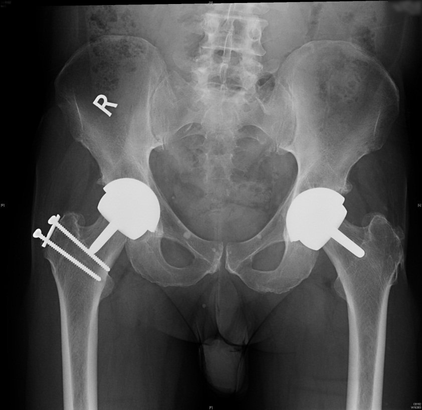 HIP JOINT SURGRERY Buyxraysonline HIP JOINT SURGRERY Buyxraysonline