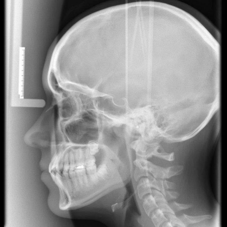 LATERAL CEPHALOGRAM | Buyxraysonline