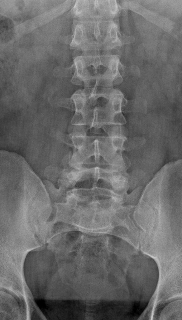LUMBAR SPINE Buyxraysonline