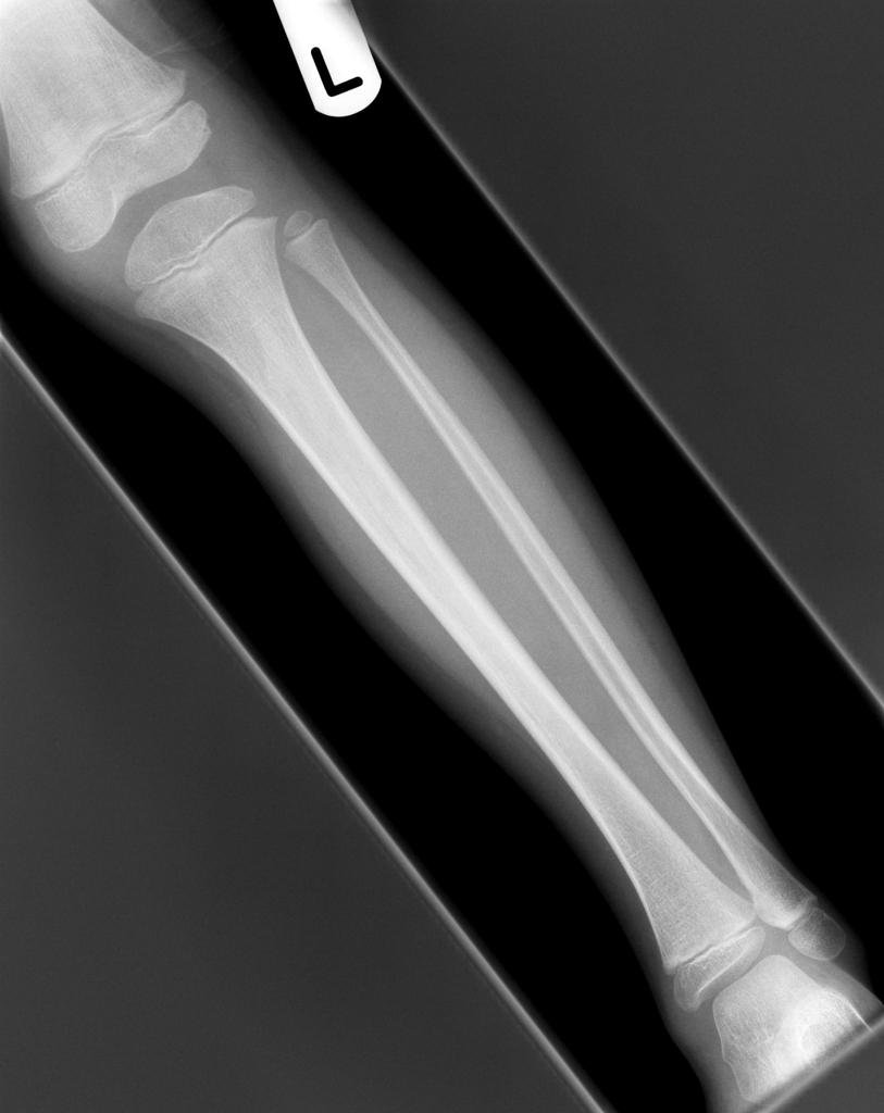 NORMAL LEG 2 Buyxraysonline NORMAL LEG 2 Buyxraysonline
