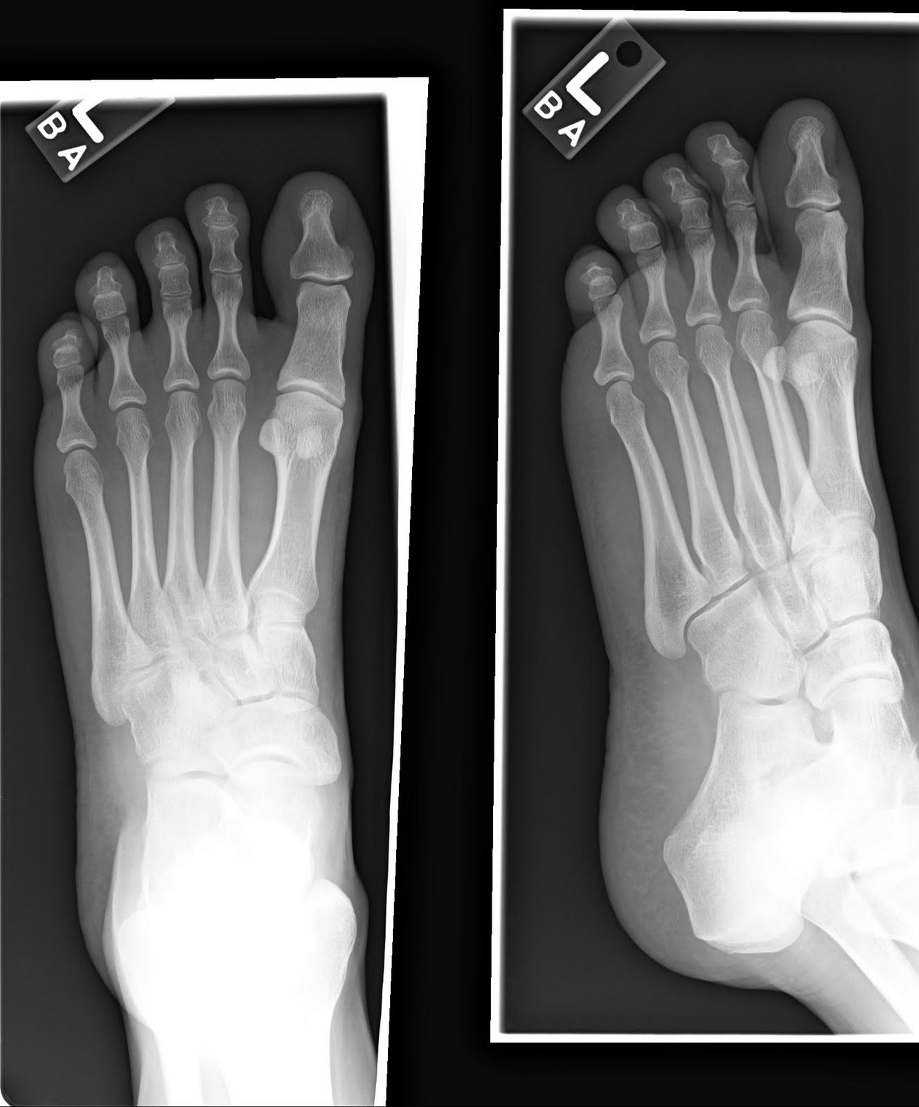 NORMAL FOOT 5 Buyxraysonline NORMAL FOOT 5 Buyxraysonline