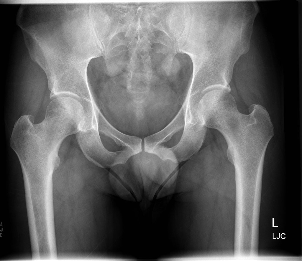 NORMAL HIP Buyxraysonline NORMAL HIP Buyxraysonline