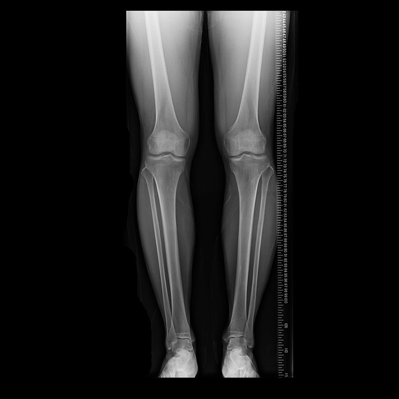 NORMAL LEG Buyxraysonline NORMAL LEG Buyxraysonline