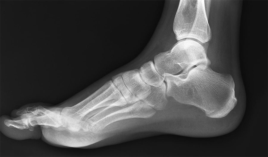 PLANTAR FASCIITIS Buyxraysonline