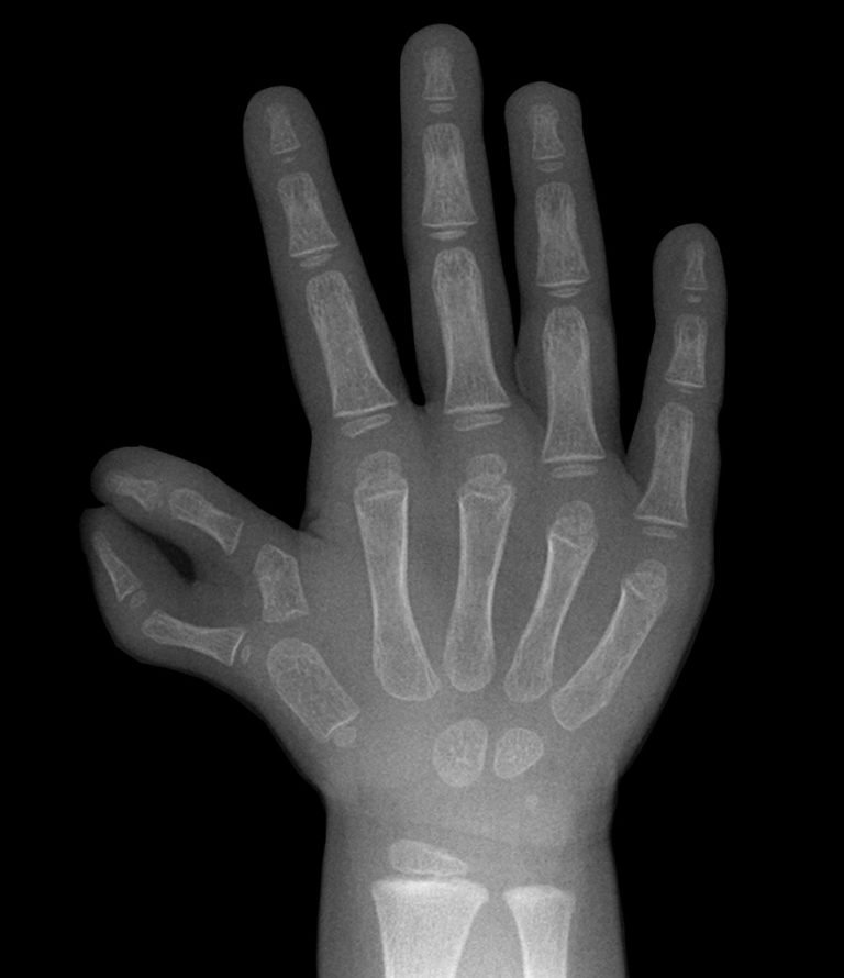 POLYDACTYLY 1 | Buyxraysonline